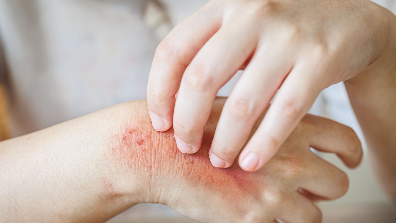 How to Soothe Your Child’s Itchy Skin - Goodnever